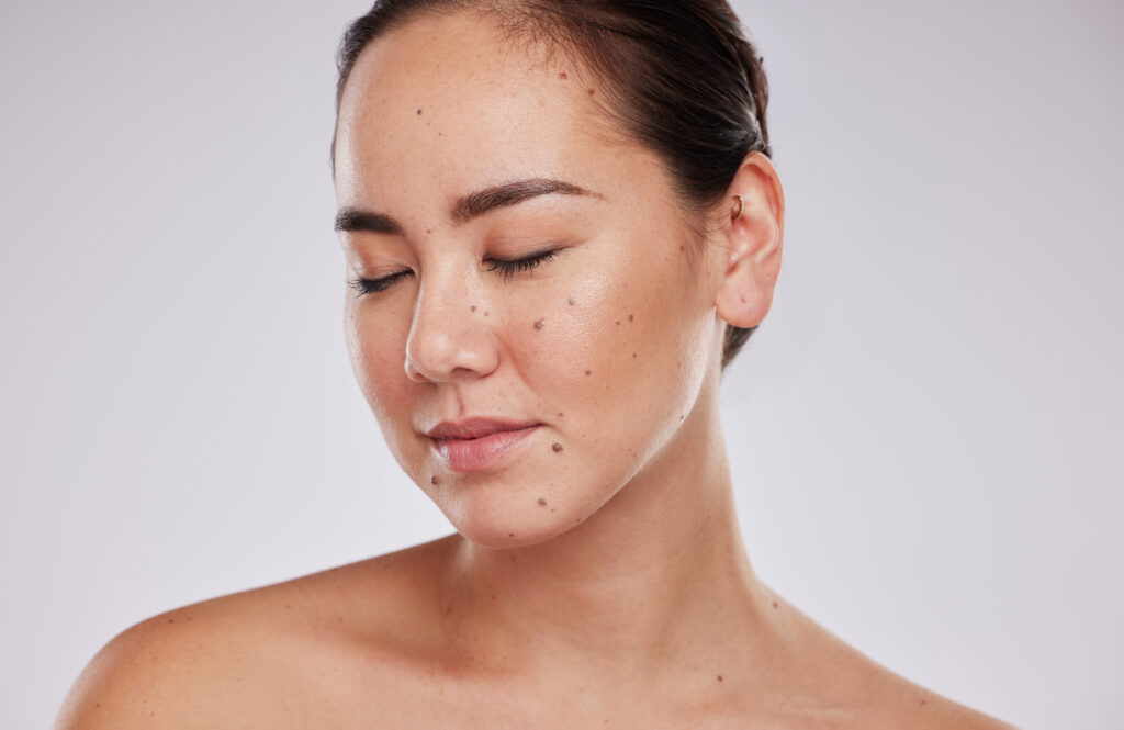Can Scarless Mole Removal Treat Raised or Flat Moles